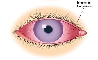 eye health and conditions | Barnham Opticians | 01243 554091